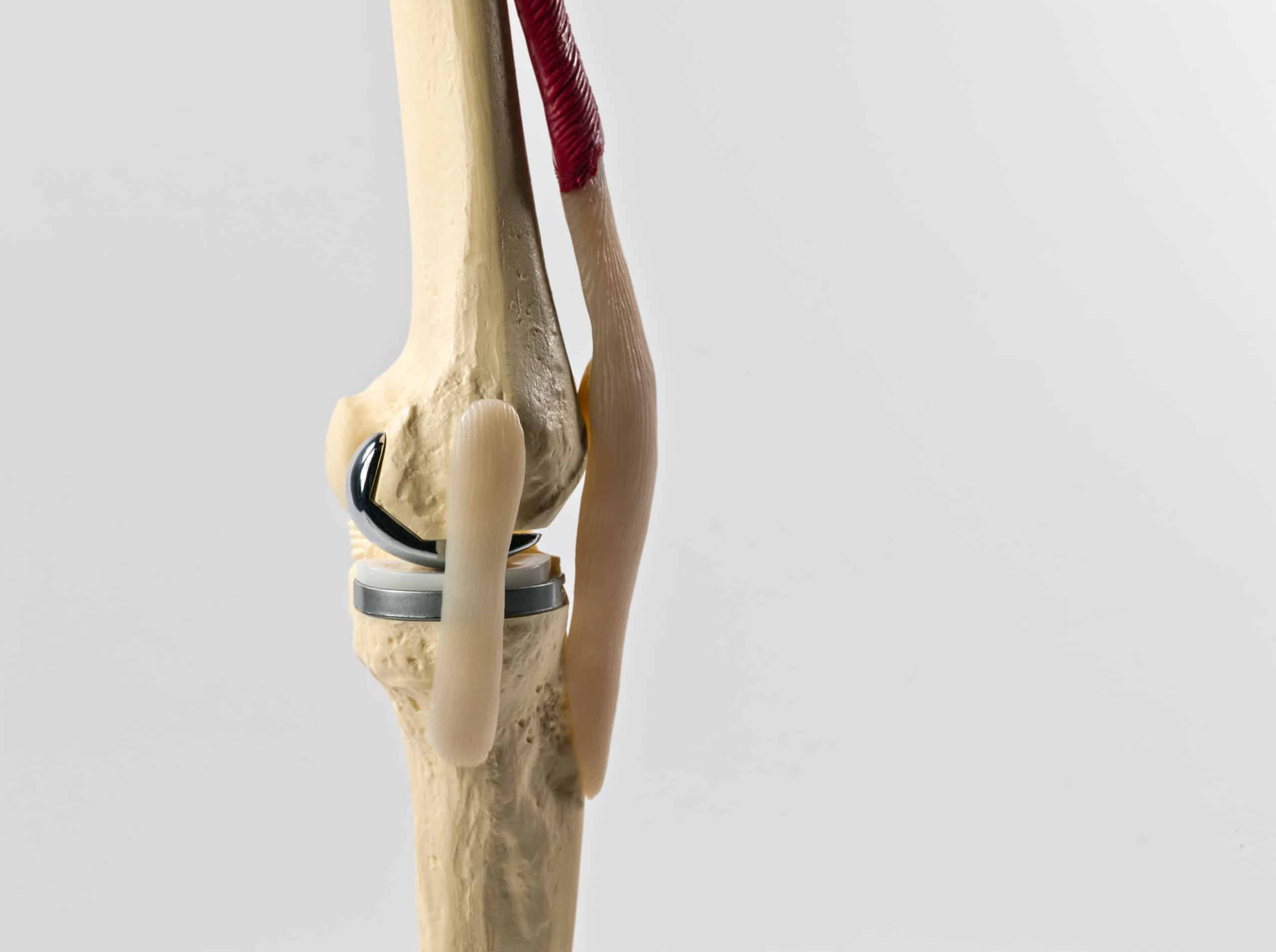 When is it time for knee replacement? - Chicago Health