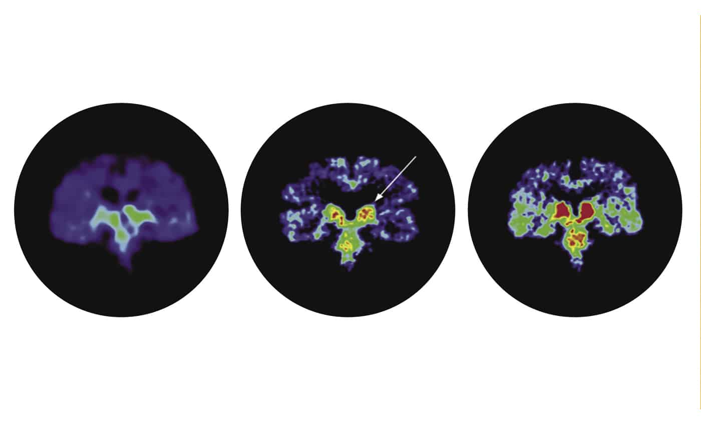 New Diagnostic Trial for CTE