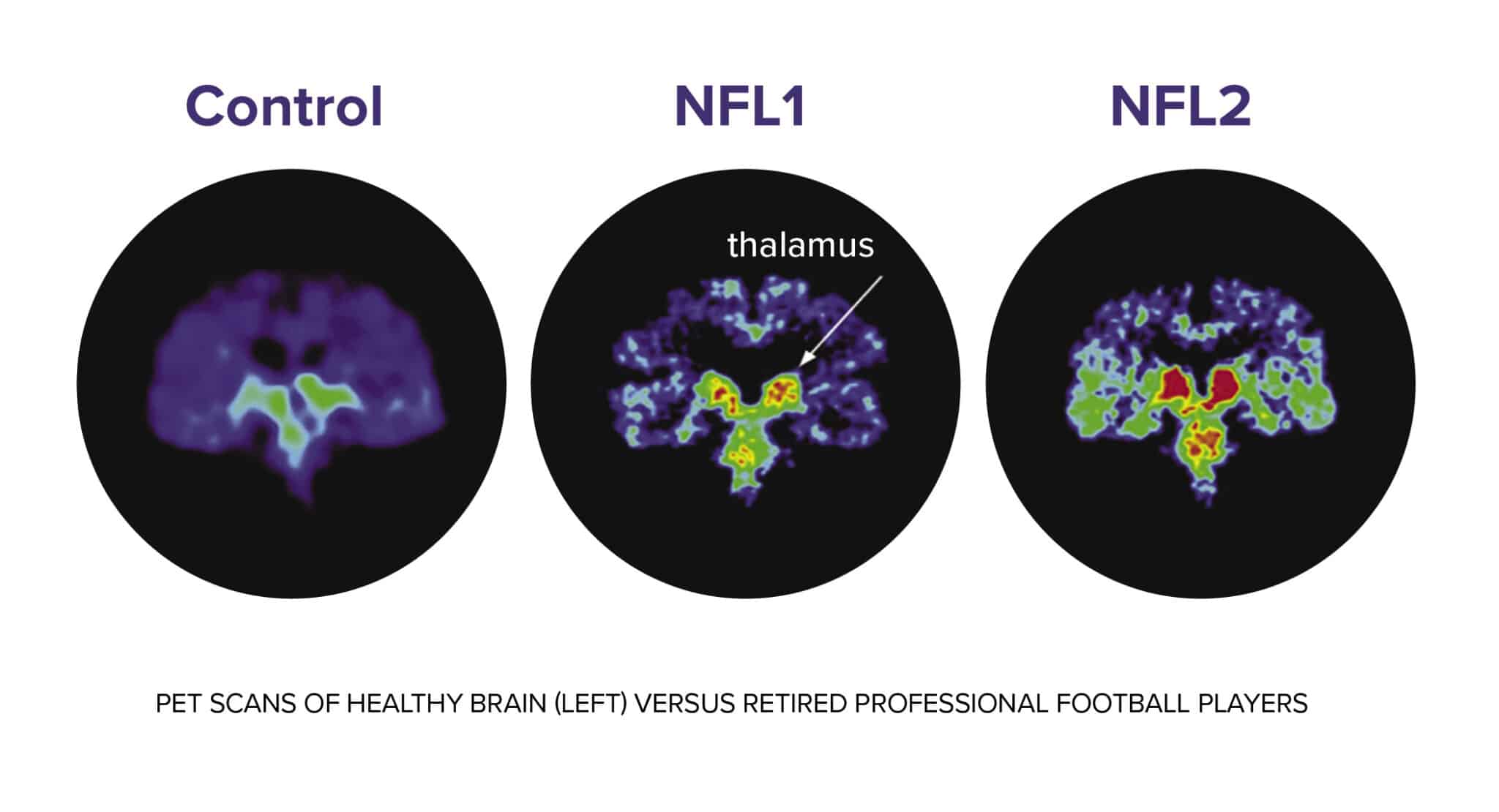 New Diagnostic Trial for CTE